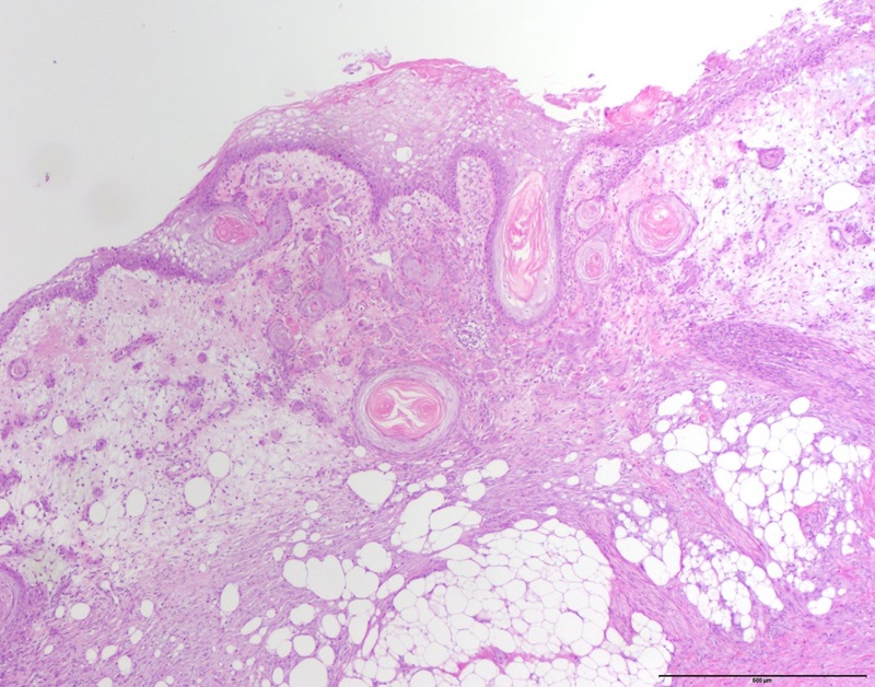 Aviair keratoacanthoma